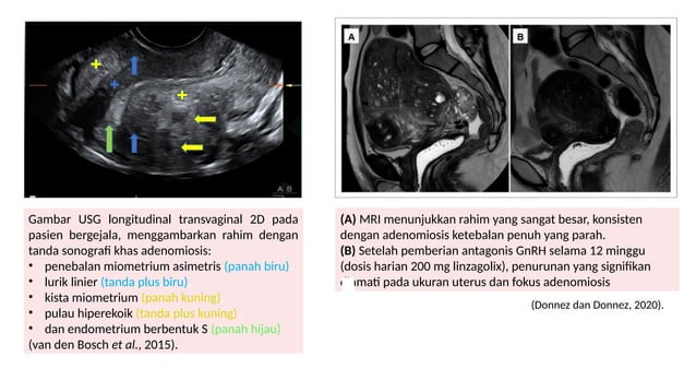 PPT PENYAKIT ADENOMYOSIS TINJAUAN PUSTAKA | PPTX