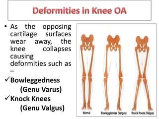 Osteoarthritis | PPTX