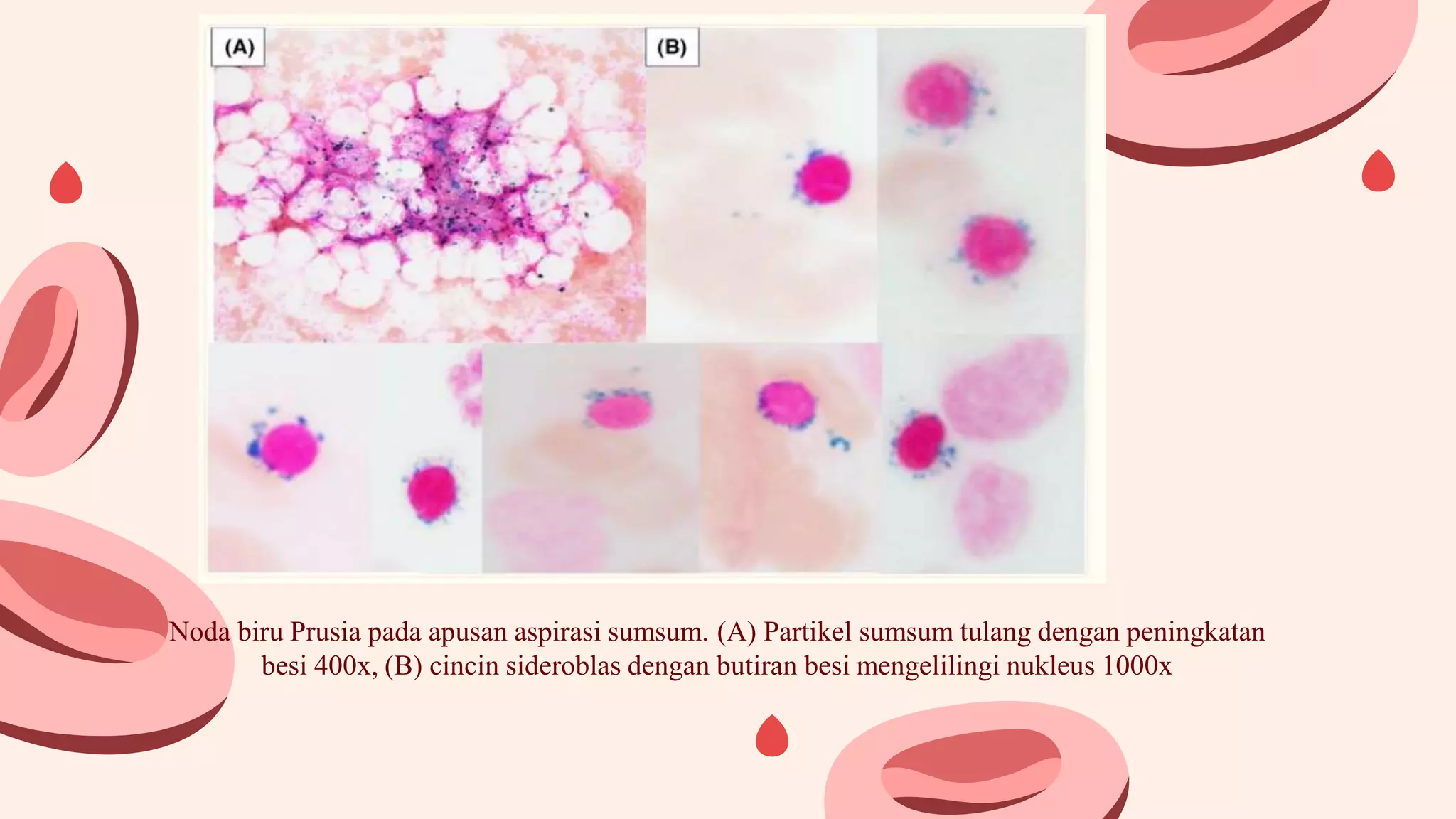 PPT Anemia Sideroblastik.pptx