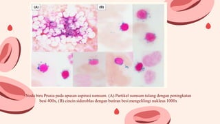 PPT Anemia Sideroblastik.pptx