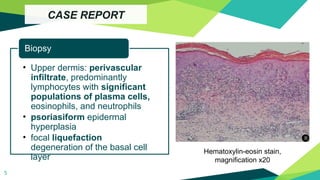 annular secondary syphilis a case report | PPTX