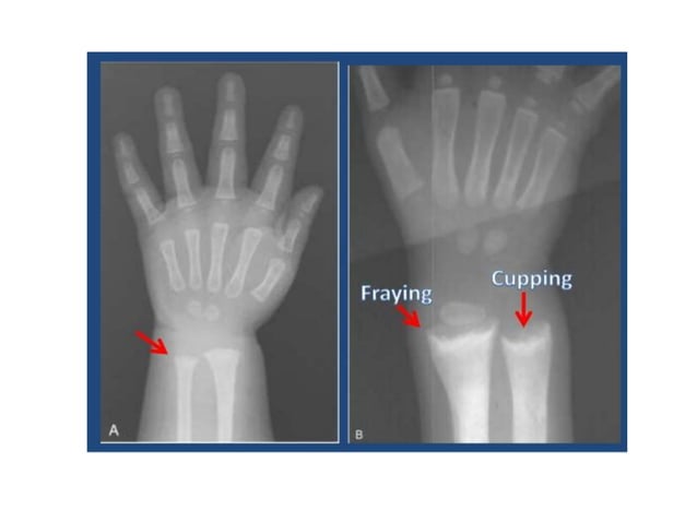 Ppt Approach to Rickets and it's Management | PPTX