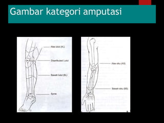 PPT ASKEP AMPUTASI.pptx