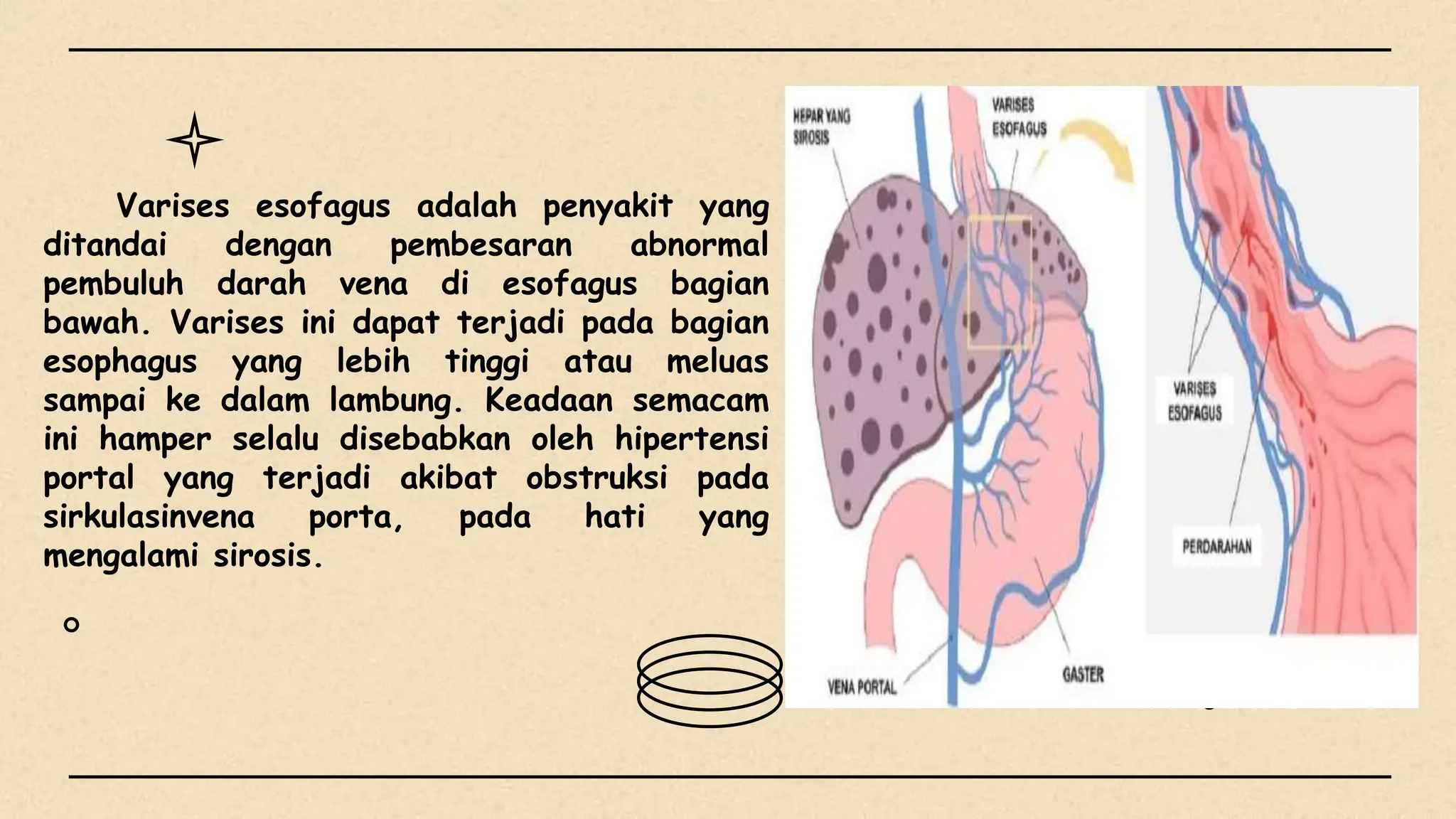 ppt askep varises esophagus baru bab 2.pptx