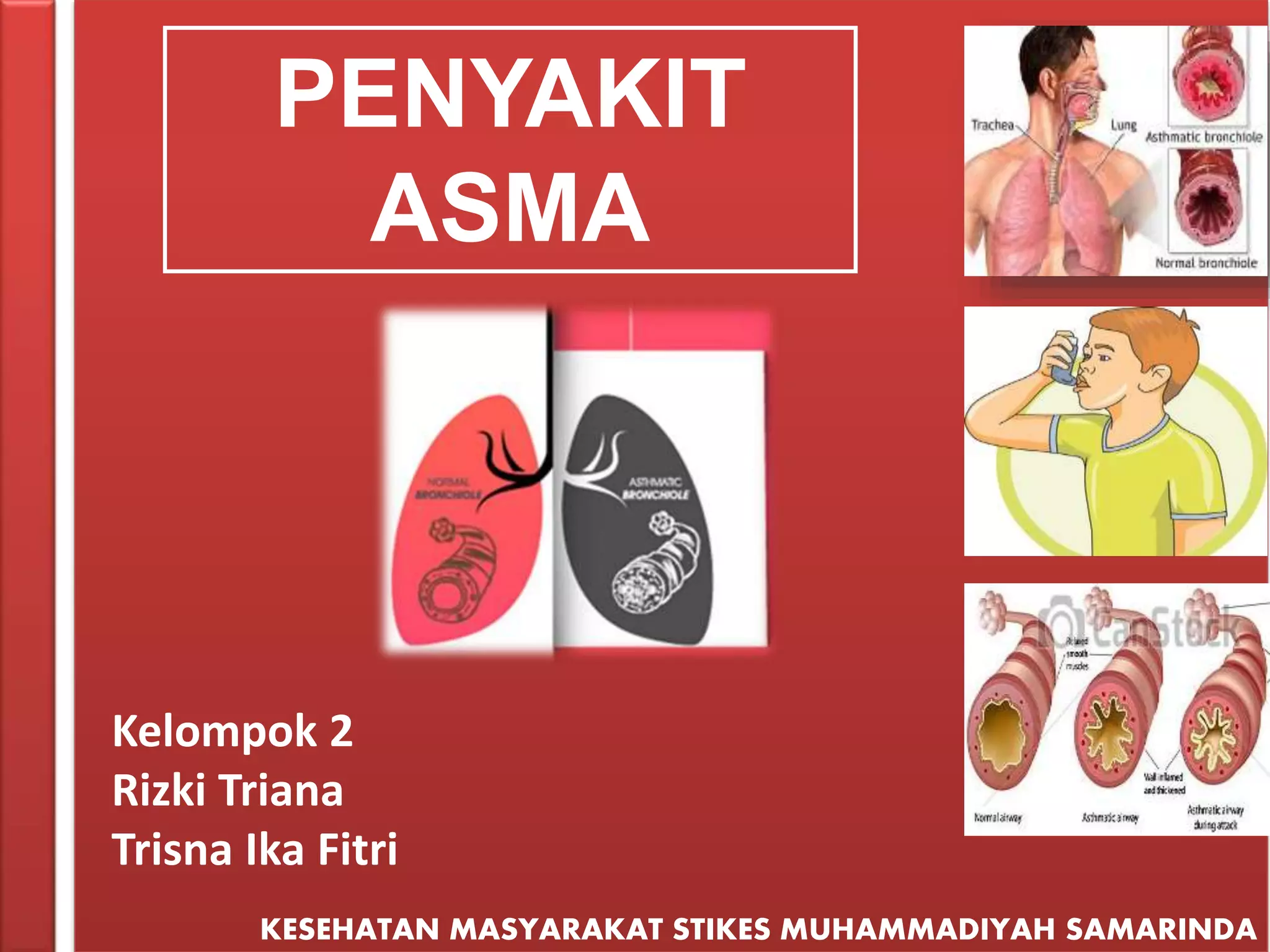 Ppt Penyakit Asma | PPTX