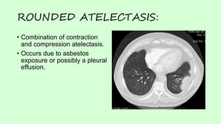 Ppt atelectasis | PPTX | Lung and Respiratory Health | Diseases and ...