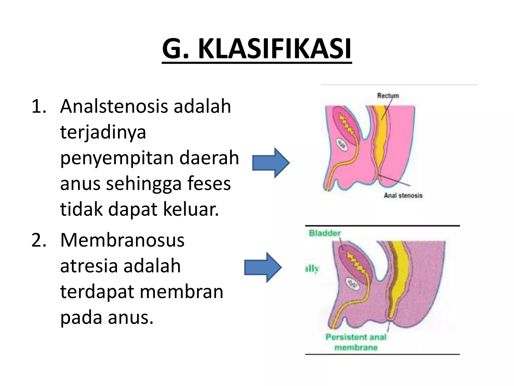 Atresia Rekti Atresia Ani | PPTX