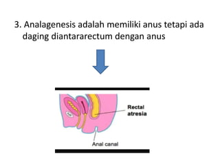 Atresia Rekti Atresia Ani | PPTX