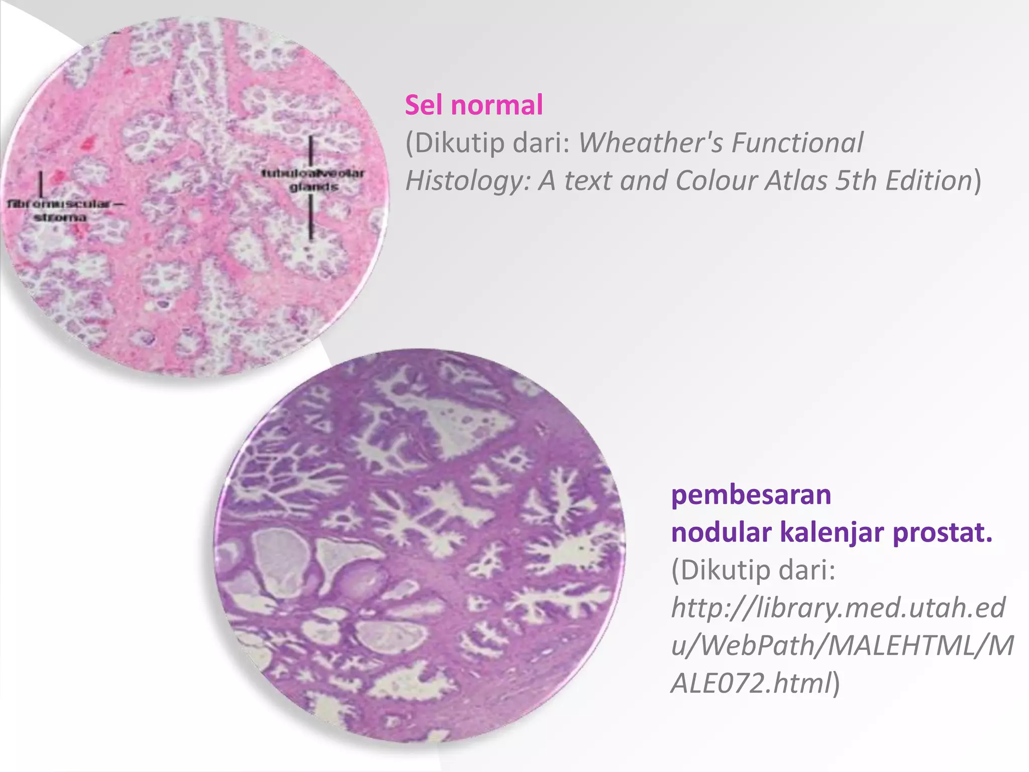 benign prostat hyperplasia | PPTX