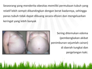 Obesitas | PPTX