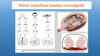 PPT BIO. GEMELI bayi kembarrrrrrrrrrrrrrrrrrrrrrrrrr | PPT