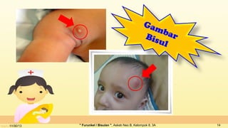Ppt Masalah pada Neonatus -- Bisulan (Furunkel) | PPT