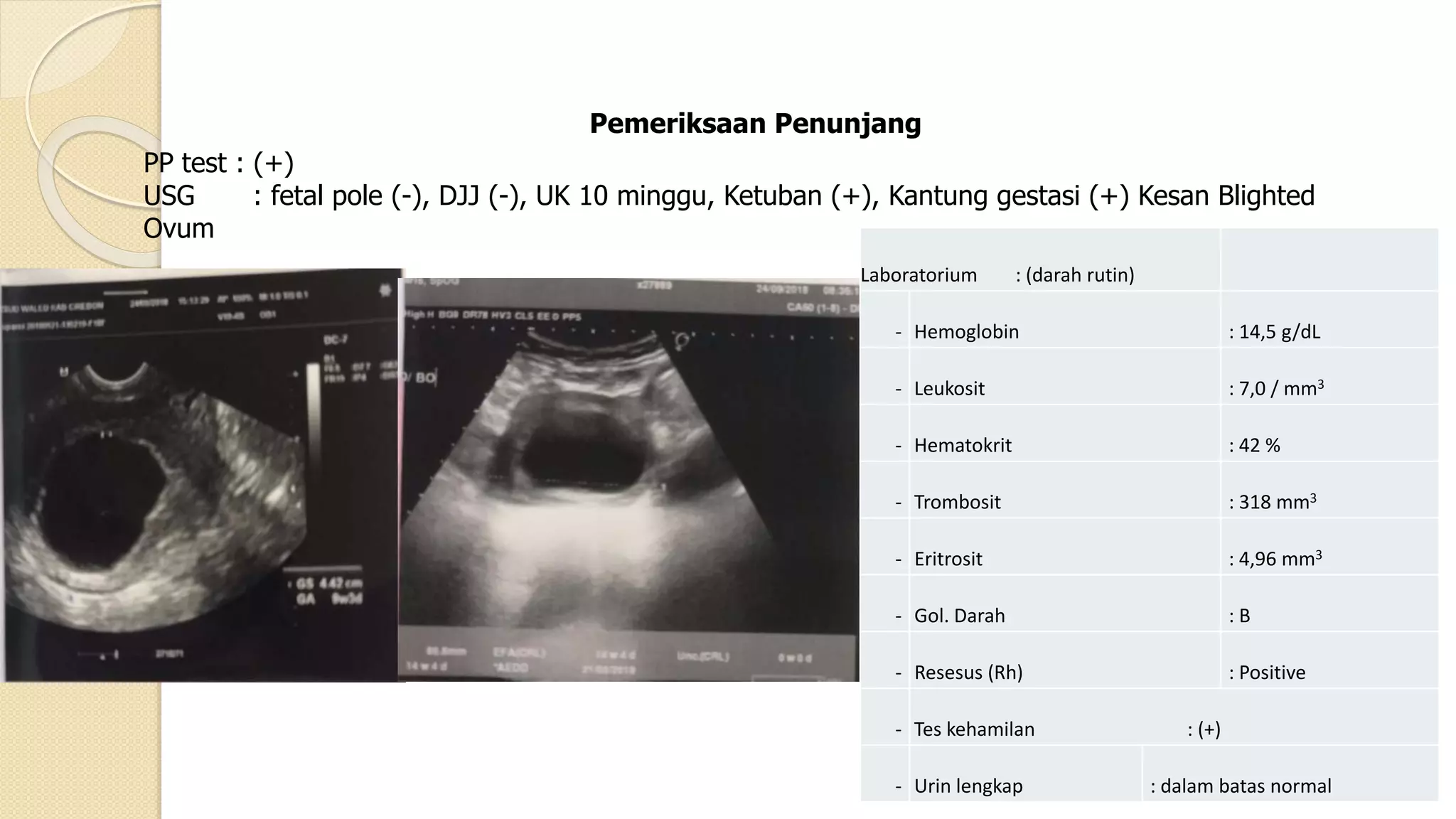 Ppt blighted ovum | PPTX
