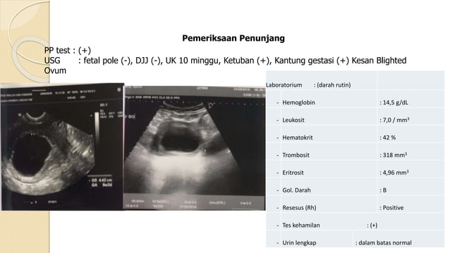 Ppt blighted ovum | PPTX