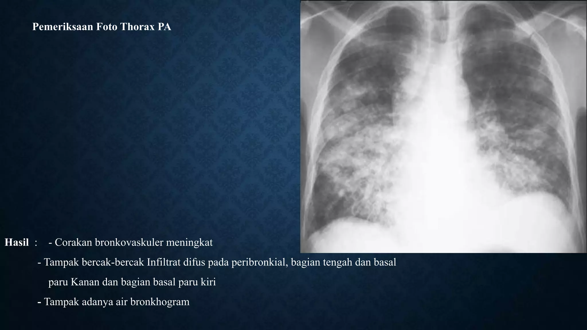 Ppt bronkopneumonia | PPTX