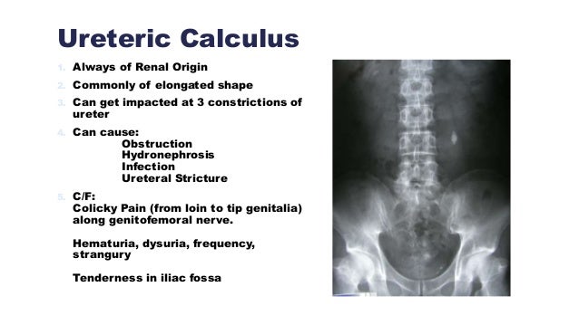 Ppt by Basheer Oudah urolithiasis imaging