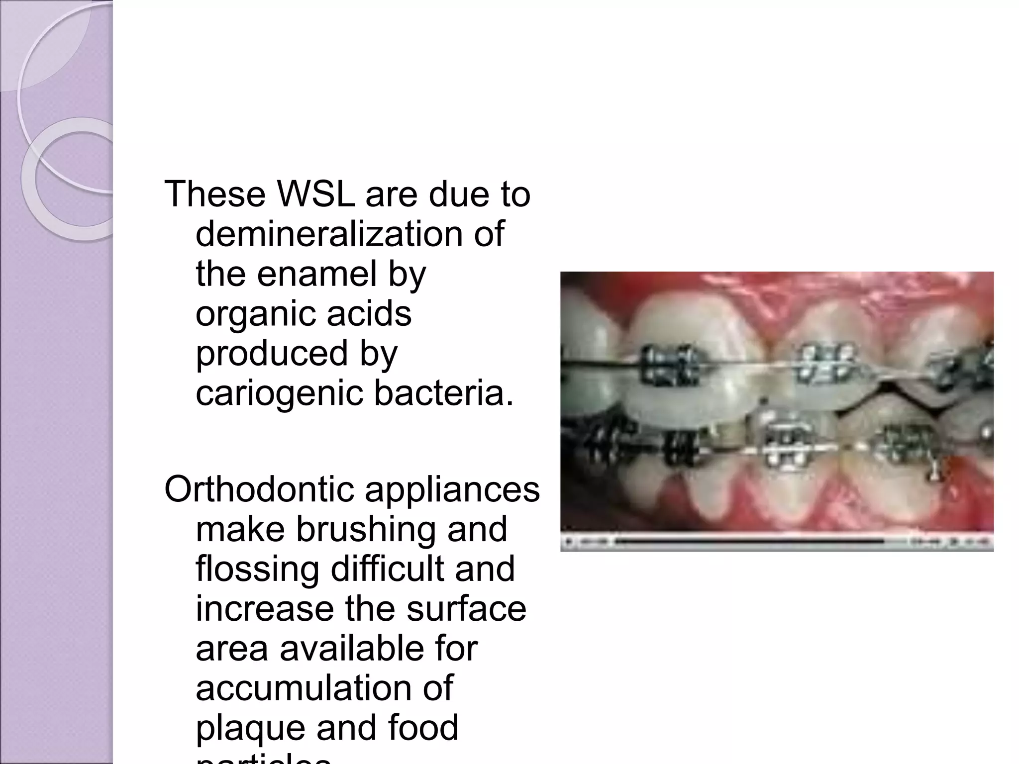 enamel demineralization in orthodontics | PPT
