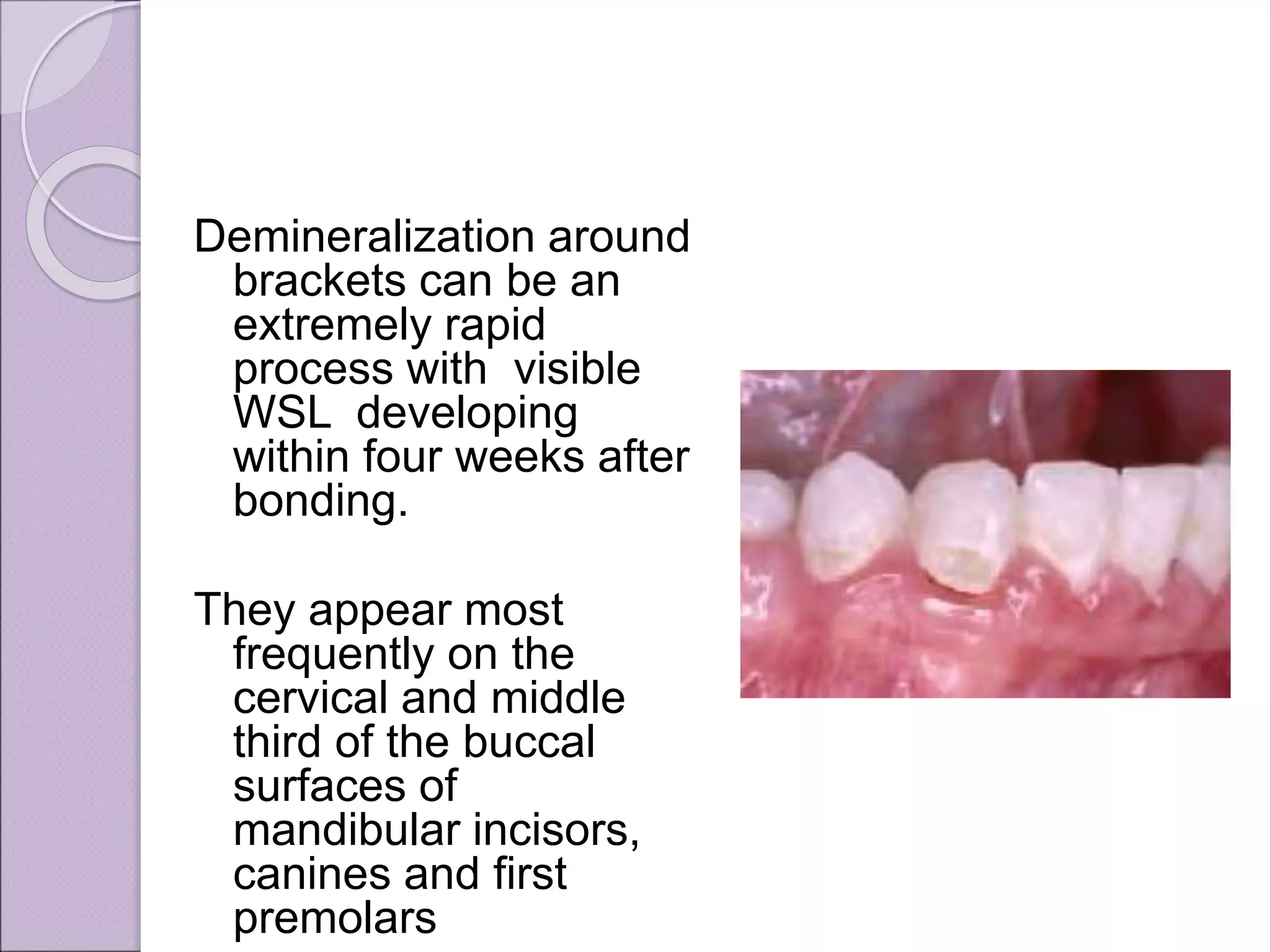 enamel demineralization in orthodontics | PPT