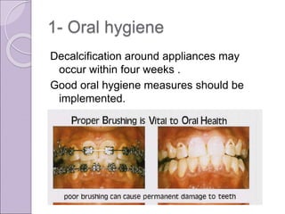Enamel Decalcification