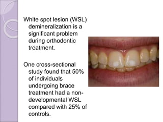 enamel demineralization in orthodontics | PPT