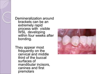 enamel demineralization in orthodontics | PPT