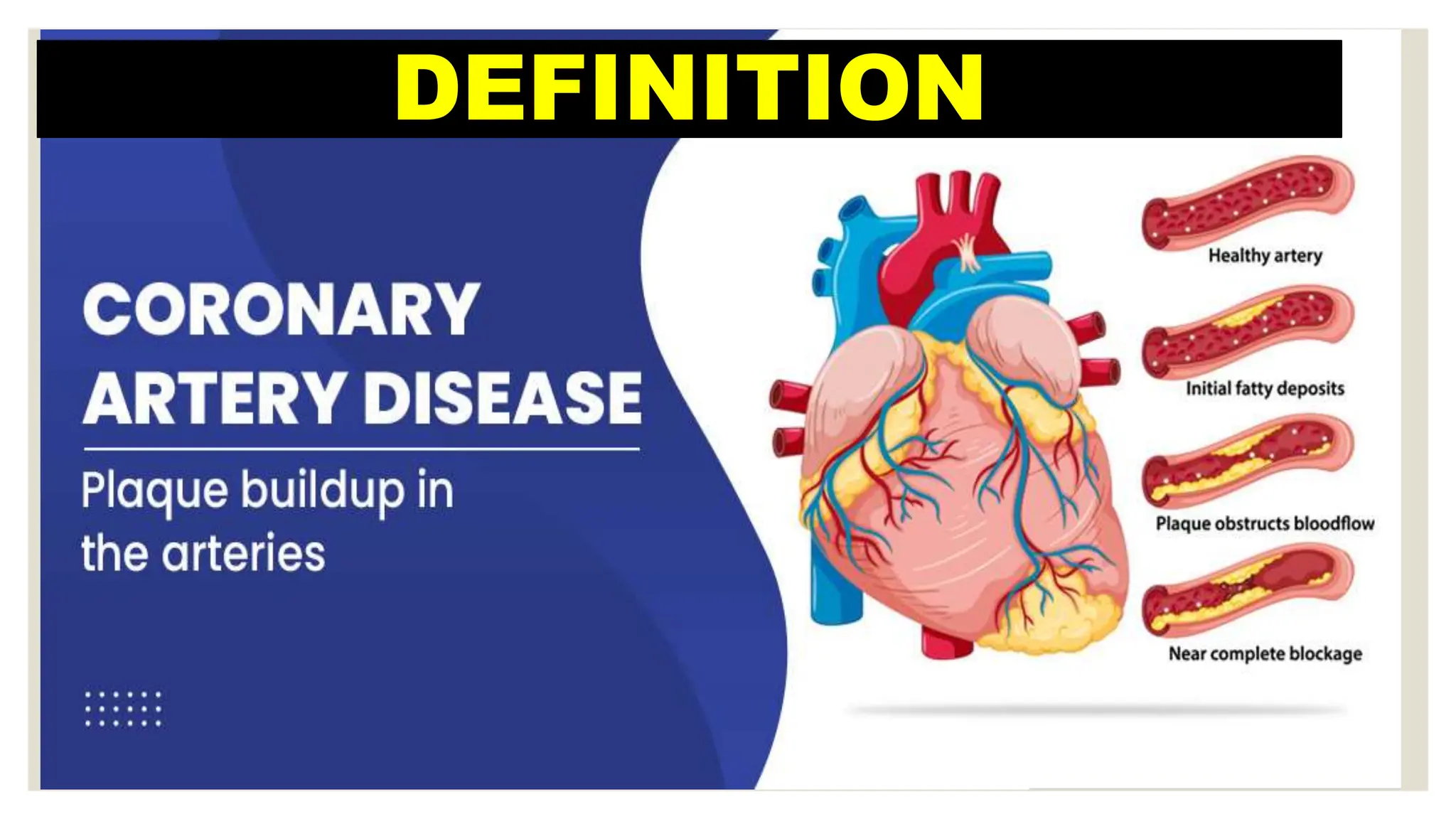 Coronary Artery Disease & Life Style Modification | PPTX