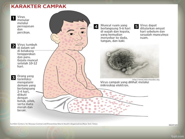 Ppt campak | PPT