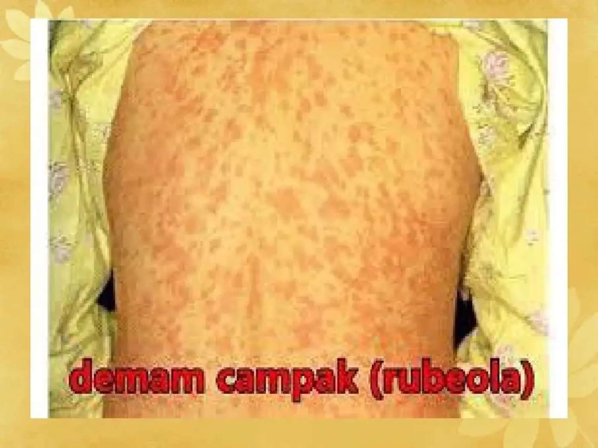 PPT tentang penyakit campak yang sangat berbahaya | PPTX