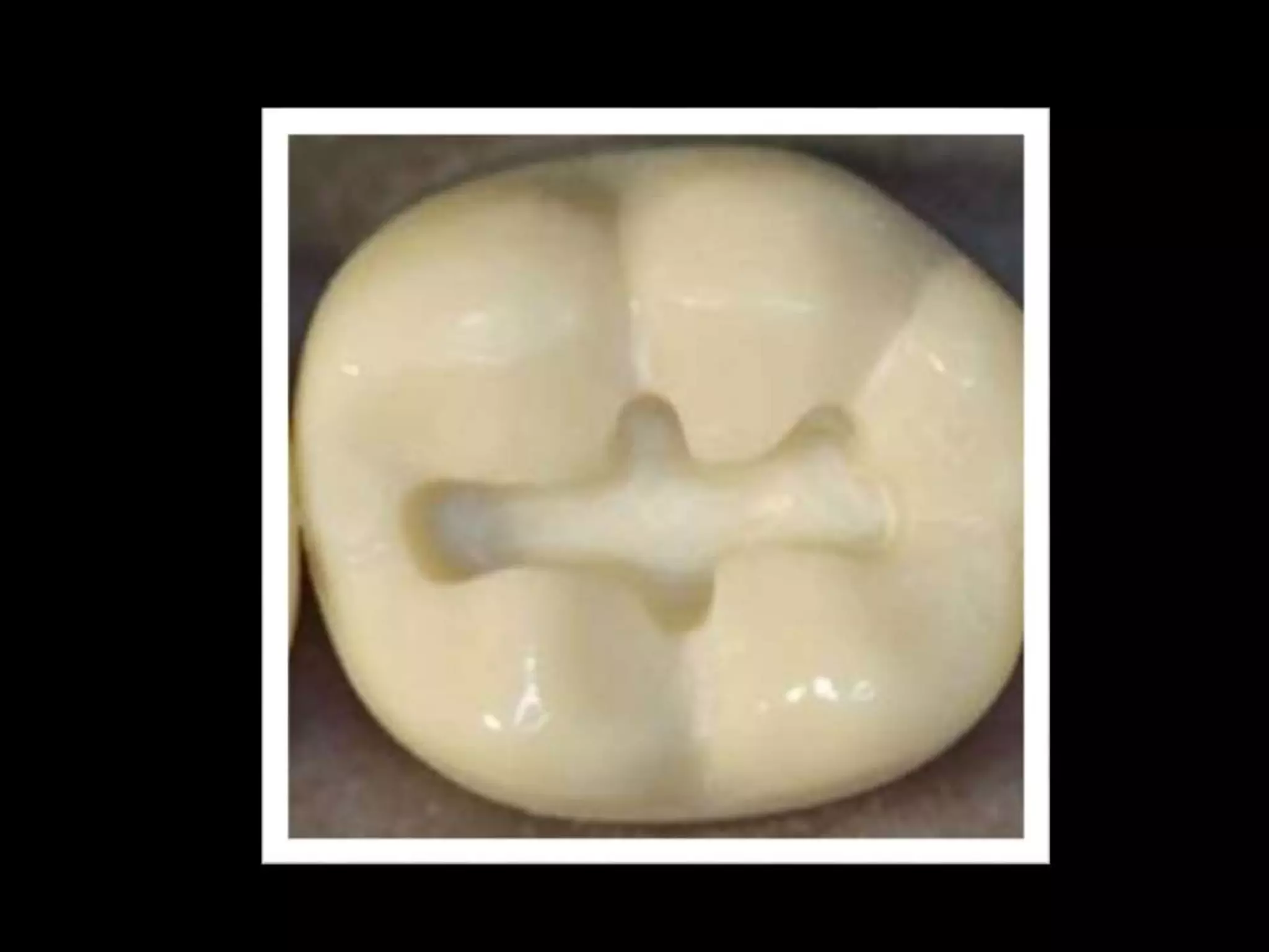 steps of cavity preparation for class 1 | PPTX