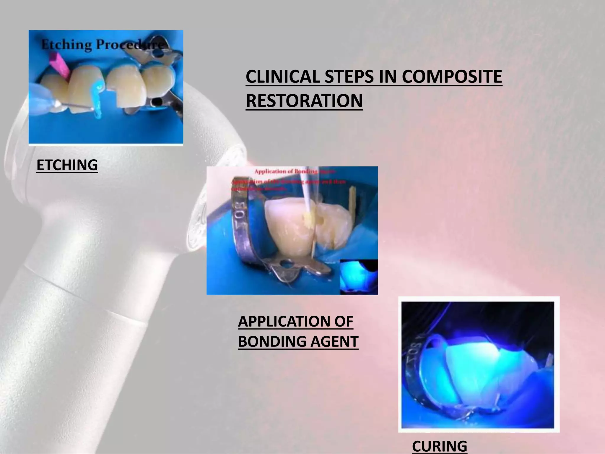 steps of cavity preparation for class 1 | PPTX