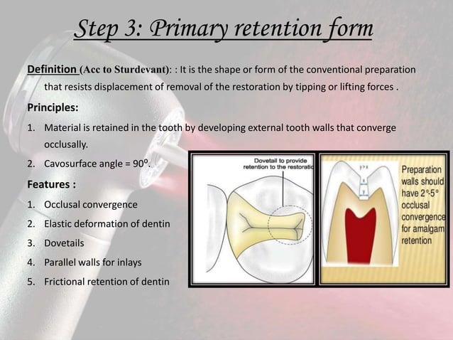steps of cavity preparation for class 1 | PPTX