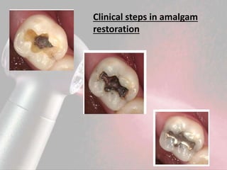 steps of cavity preparation for class 1 | PPTX