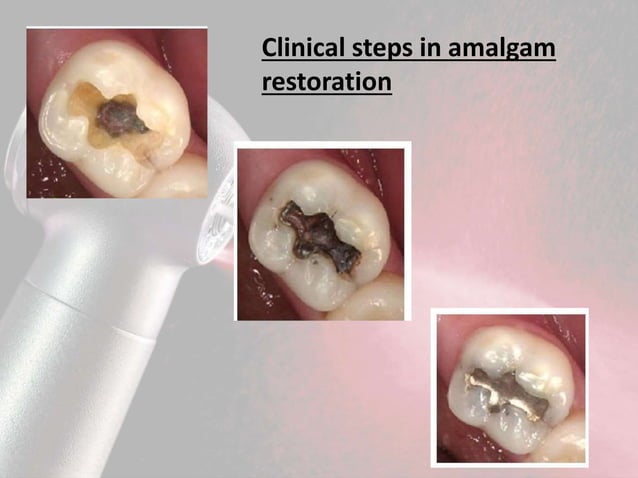 steps of cavity preparation for class 1 | PPTX