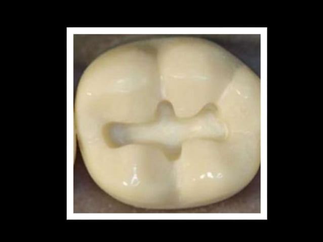 steps of cavity preparation for class 1 | PPTX