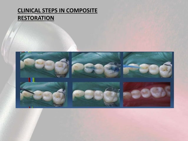 steps of cavity preparation for class 1 | PPTX