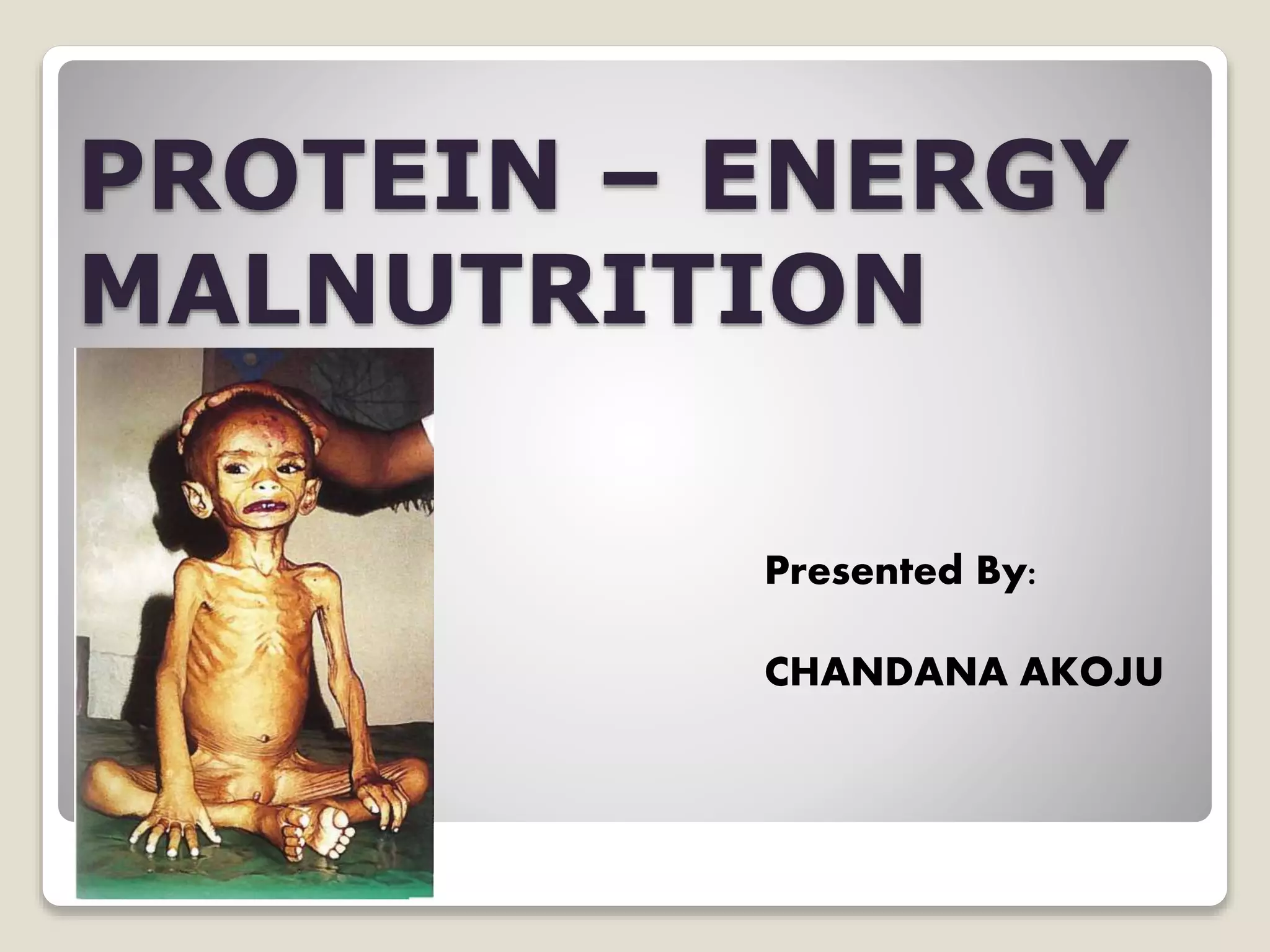 Protein energy malnutrition(PEM) | PPTX