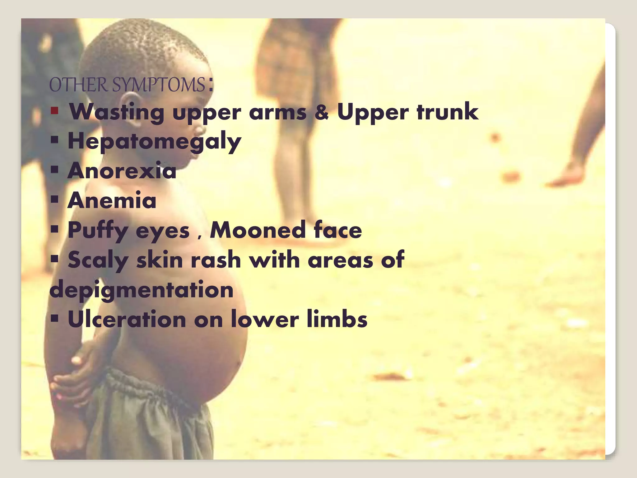Protein energy malnutrition(PEM) | PPTX