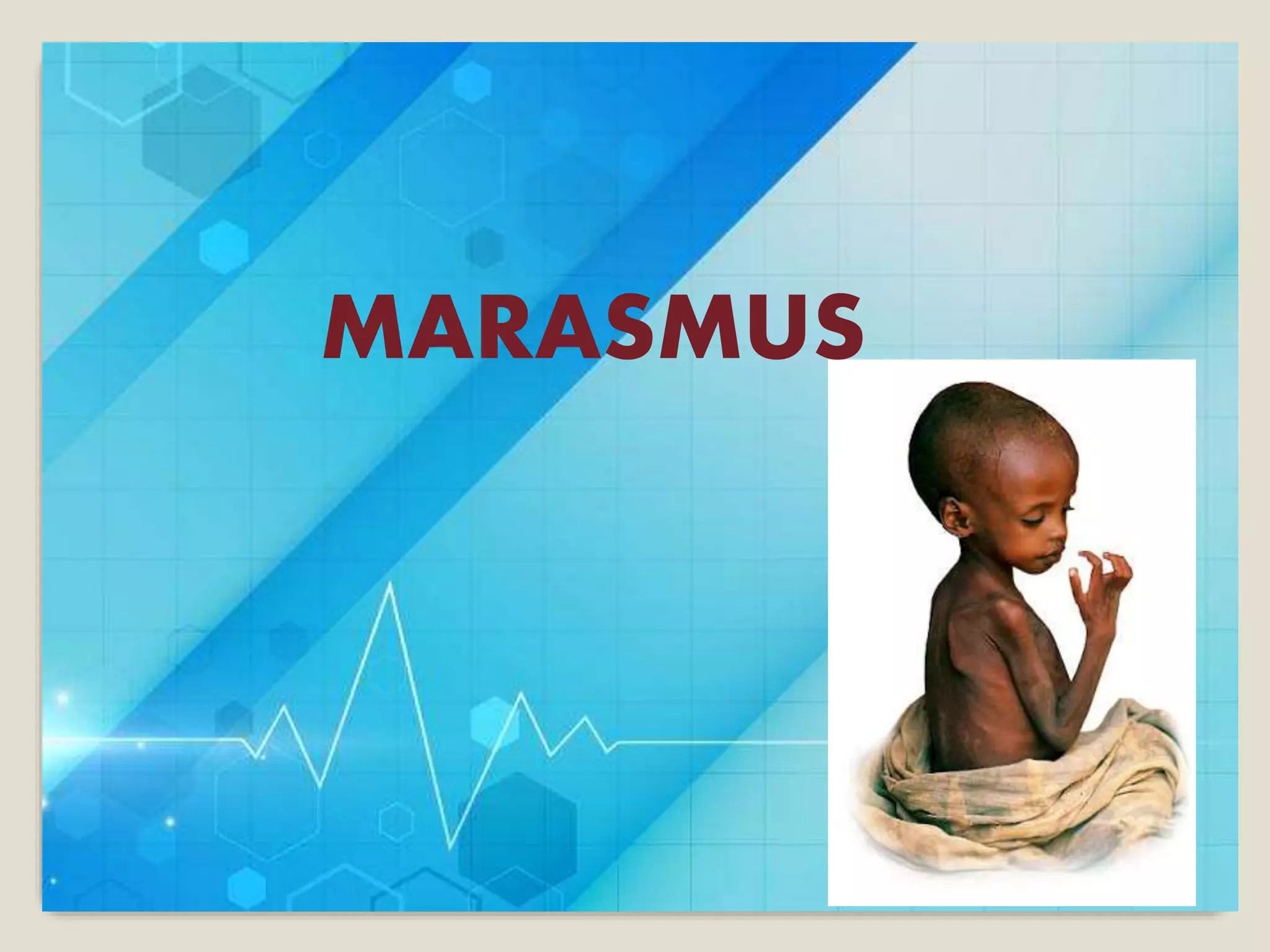 Protein energy malnutrition(PEM) | PPTX