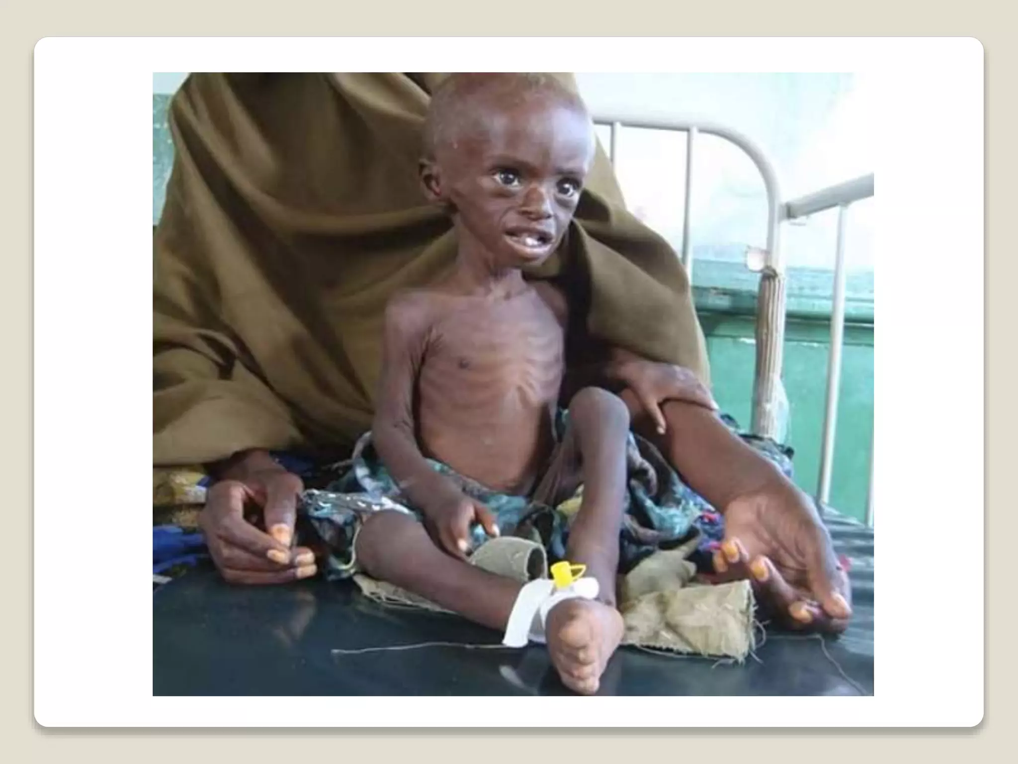 Protein energy malnutrition(PEM) | PPTX