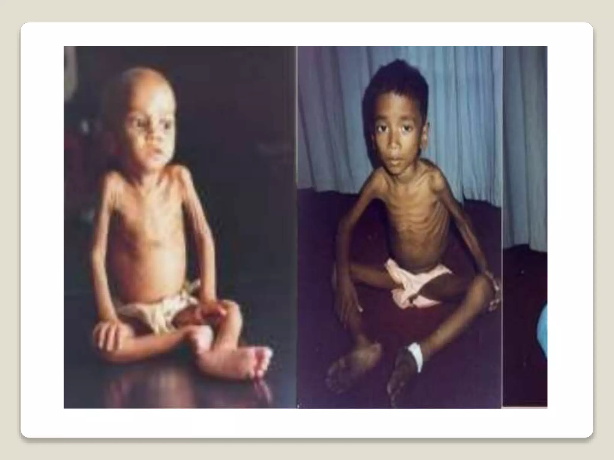 Protein energy malnutrition(PEM) | PPTX