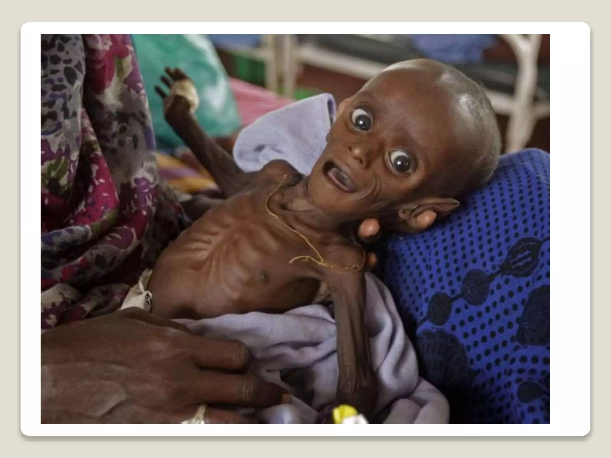 Protein energy malnutrition(PEM) | PPTX