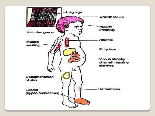 Protein energy malnutrition(PEM) | PPTX | Blood Disorders | Diseases ...