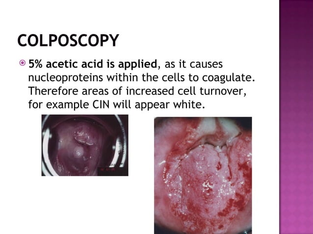 gynaecology.CIN.(dr.mraim)