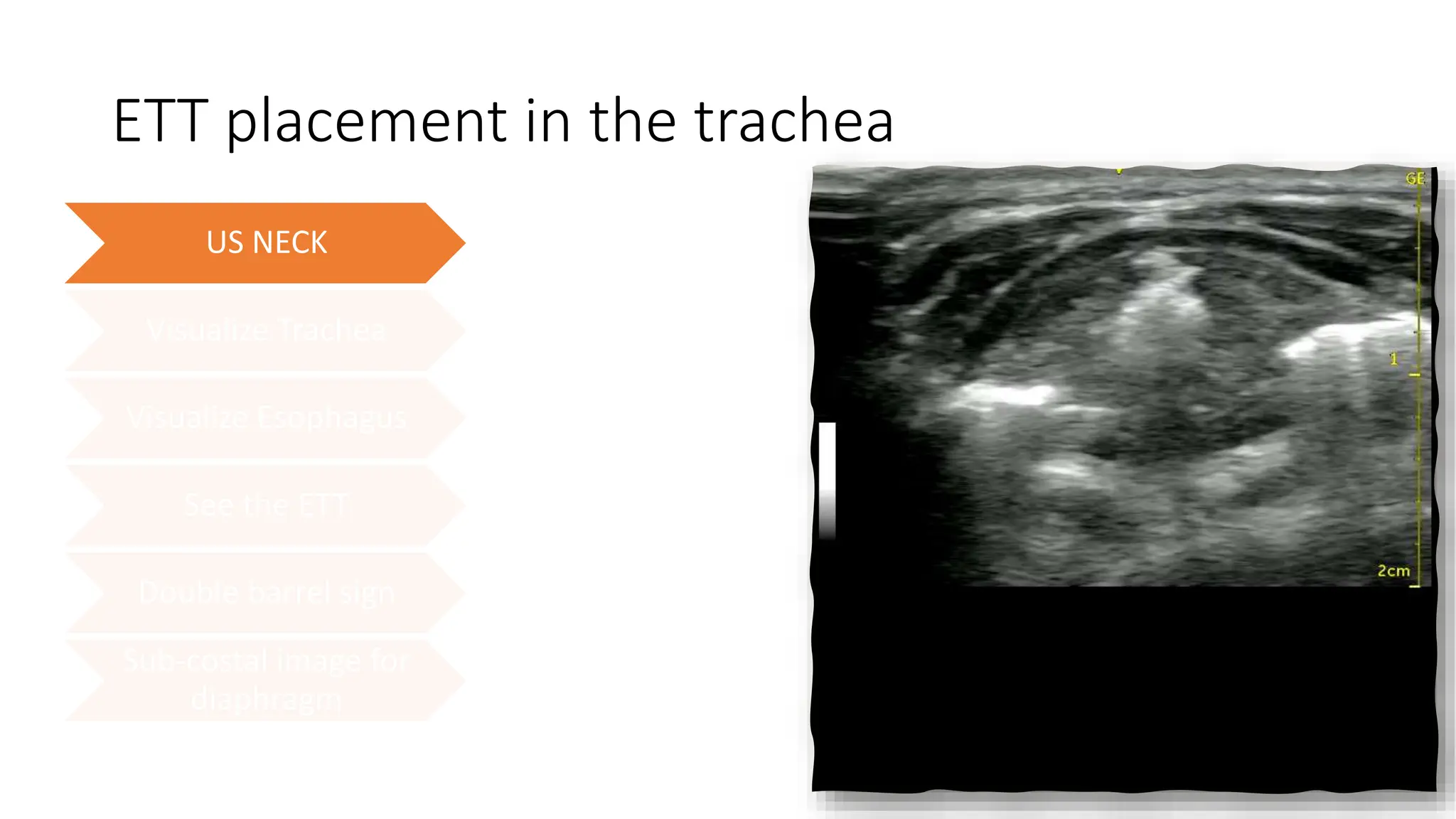 ETT ultrasound; ultrasonography of endotracheal tube placement | PPTX