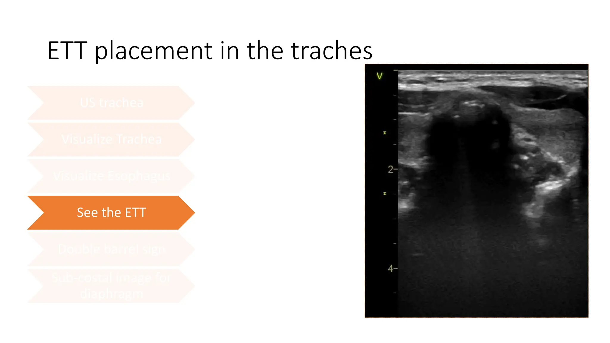 ETT ultrasound; ultrasonography of endotracheal tube placement | PPTX