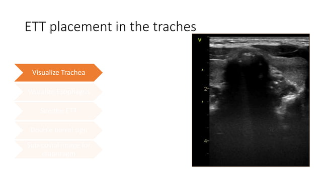 ETT ultrasound; ultrasonography of endotracheal tube placement | PPT