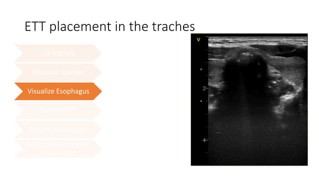 ETT ultrasound; ultrasonography of endotracheal tube placement | PPTX