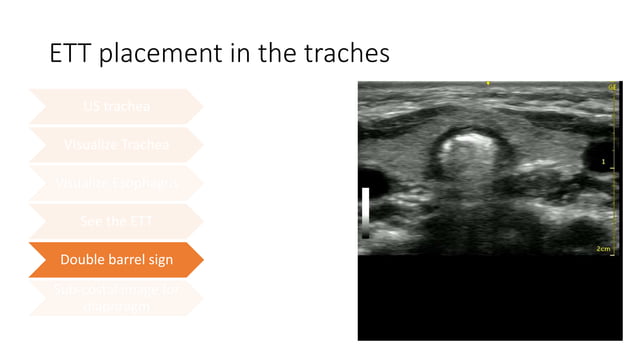 ETT ultrasound; ultrasonography of endotracheal tube placement | PPTX