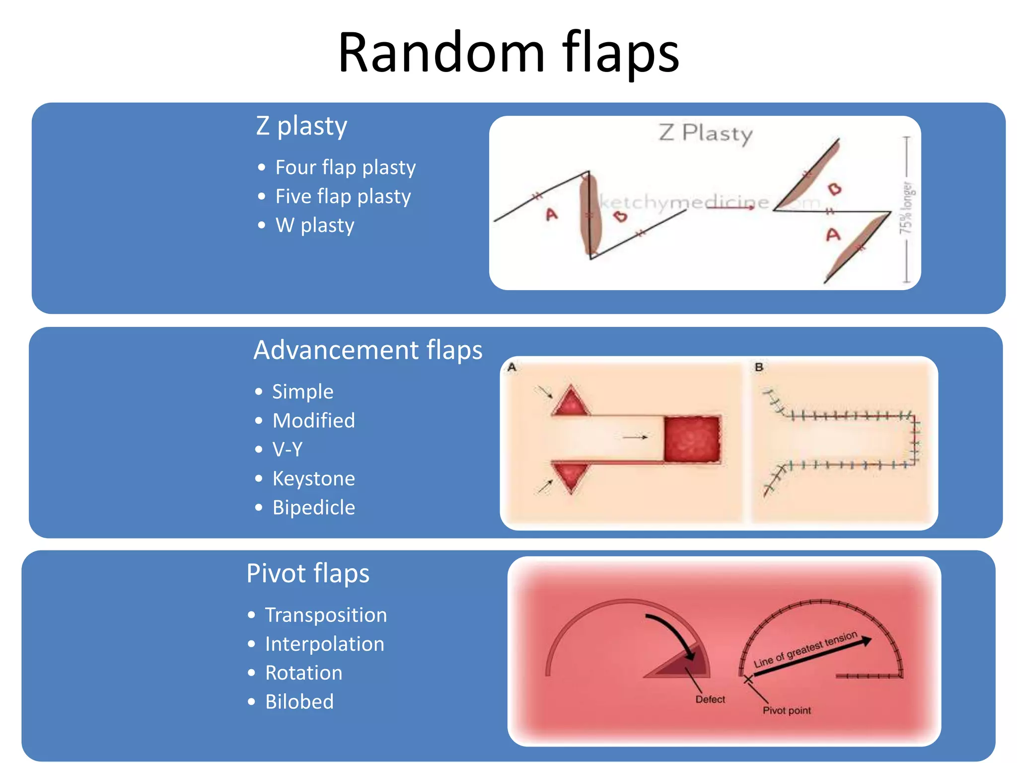 Classification of flaps | PPTX