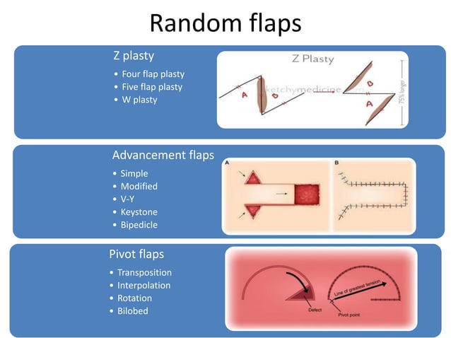 Classification of flaps | PPTX